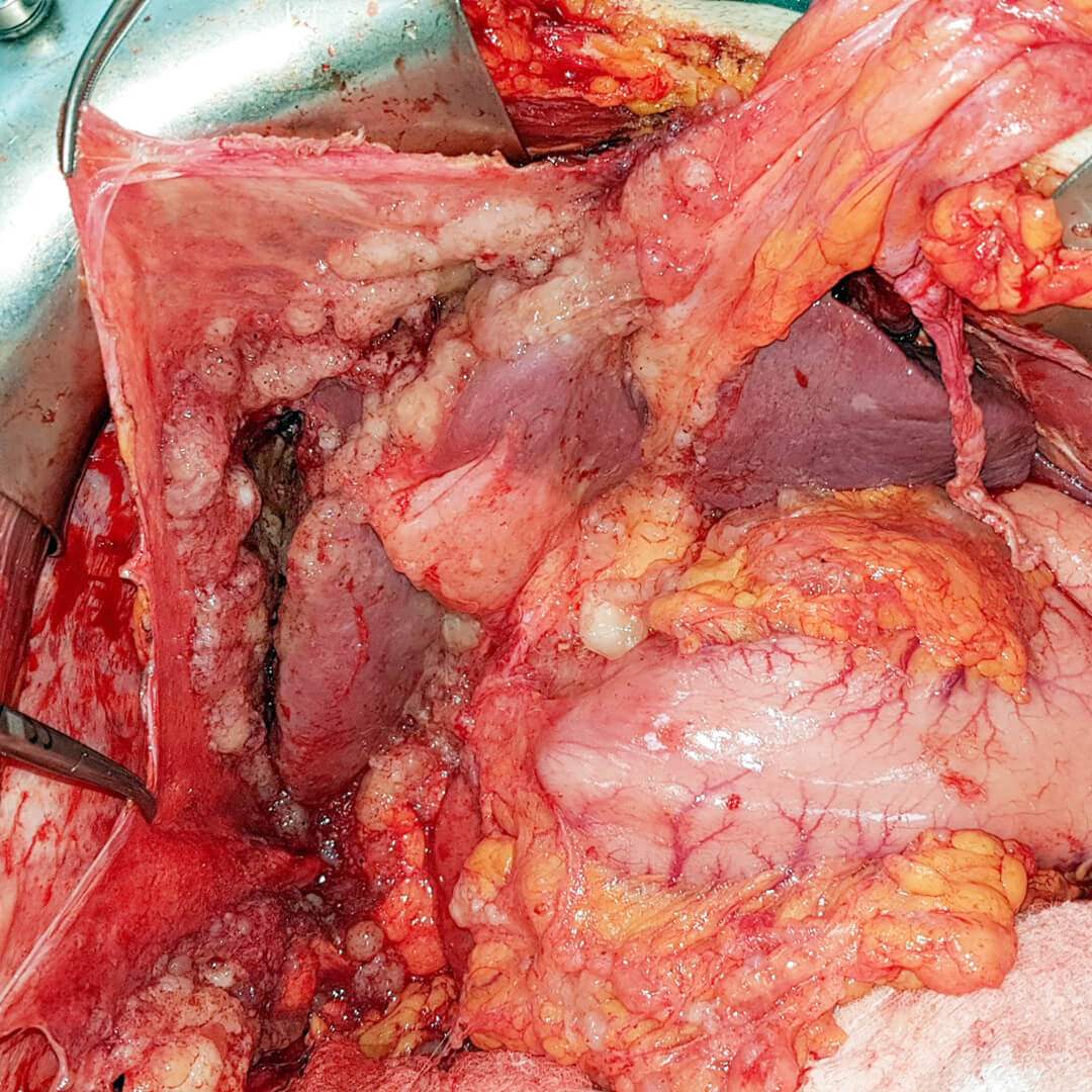 Karın Zarı Kanseri – Hipek | Aras Emre CANDA