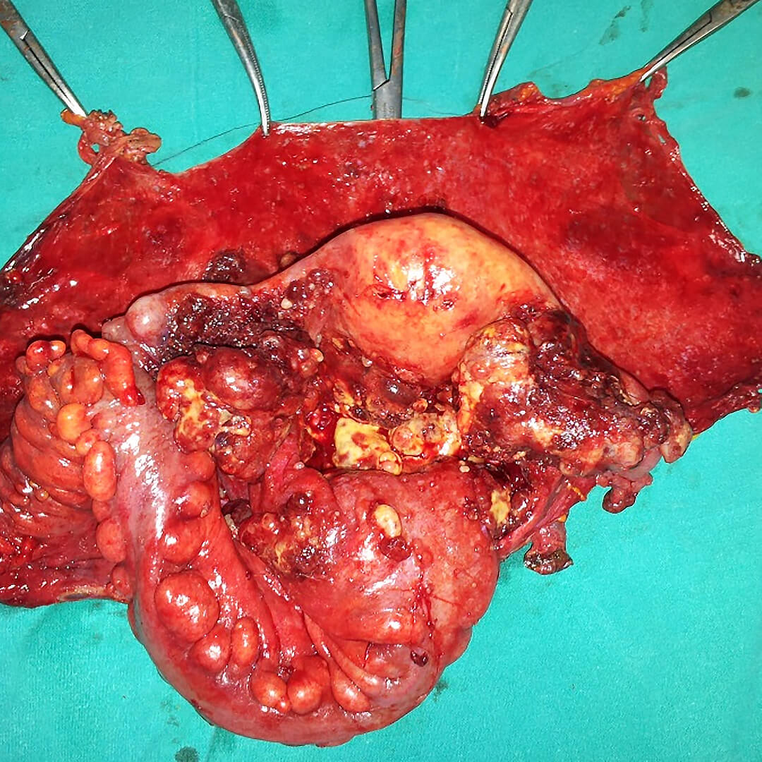 Karın Zarı Kanseri – Hipek | Aras Emre CANDA