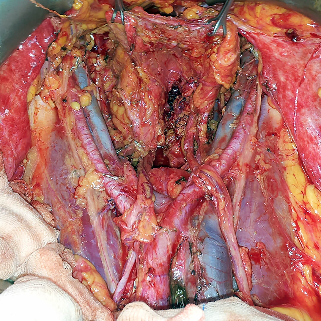 Karın Zarı Kanseri – Hipek | Aras Emre CANDA